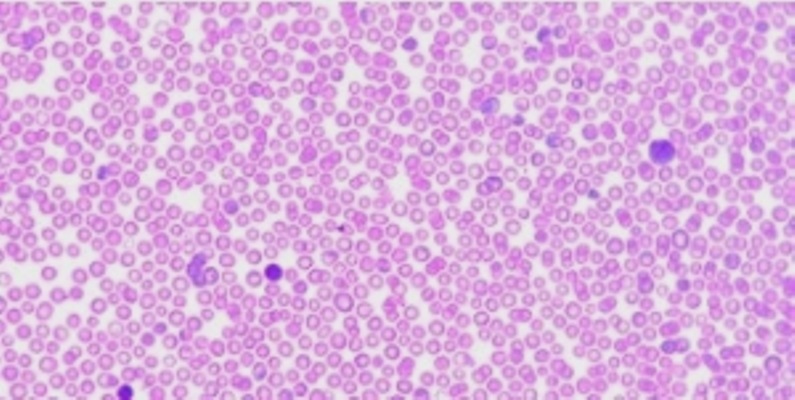 Leucémie Myéloîde chronique: L’espoir d'un traitement sans risque de ...